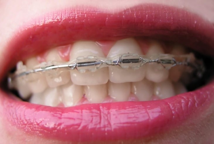 Braces & Orthodontics in Spokane, WA - 5 Mile Smiles