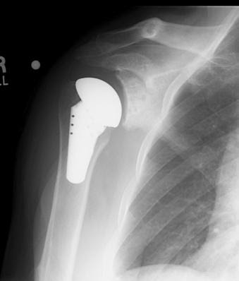 Shoulder Replacement Chillicothe - Shoulder Arthroplasty