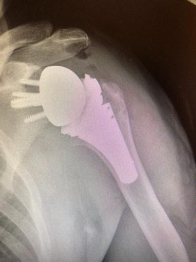Shoulder Replacement Chillicothe - Shoulder Arthroplasty