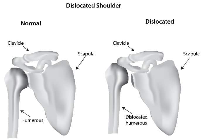Arthroscopic Shoulder Stabilization Surgery Chillicothe OH