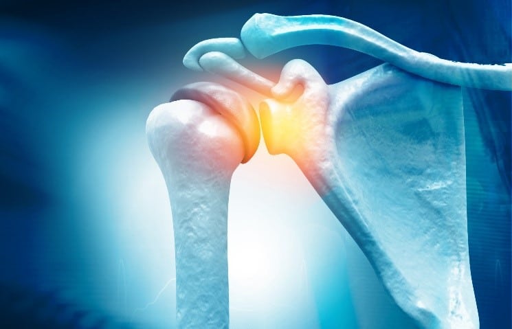Shoulder Arthroscopy Columbus OH - Shoulder Pain Surgery