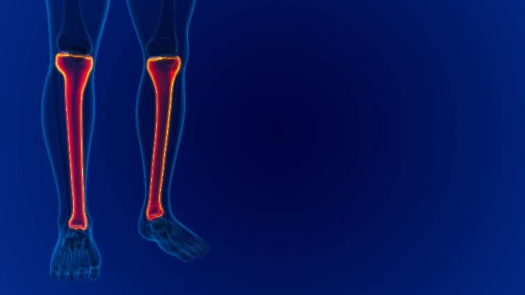 Proximal Tibia Fracture Treatment Chillicothe OH