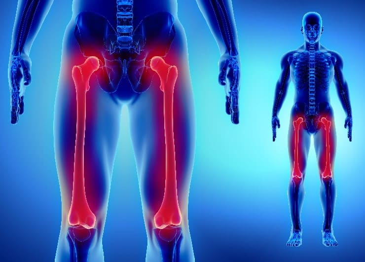 Distal Femur Fracture Treatment Chillicothe, OH - Total Knee Replacement