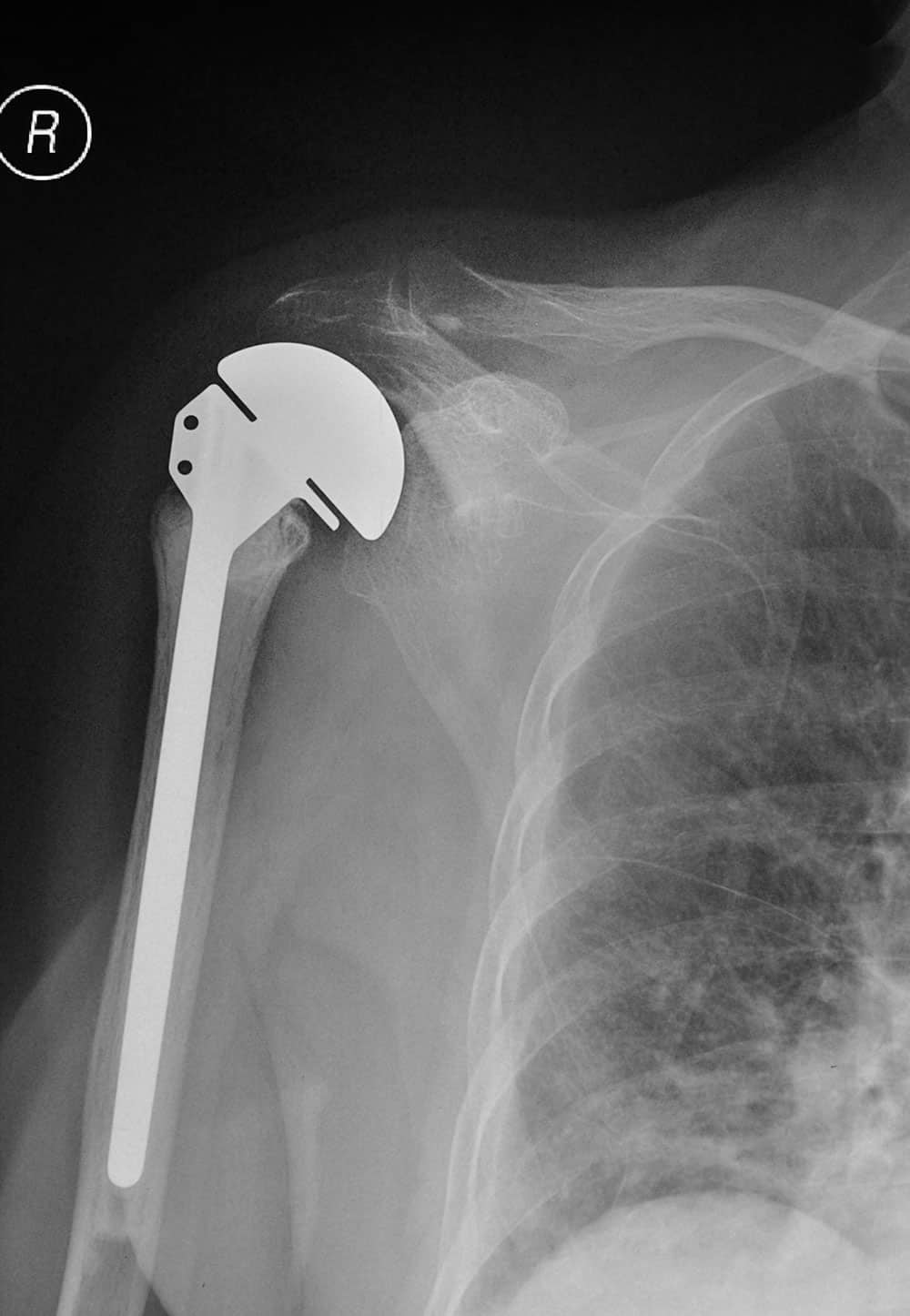 MCL Tear Surgery Burr Ridge IL - MCL Treatment Plainfield IL