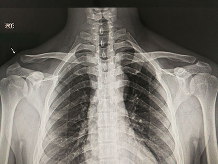 Shoulder Separation Burr Ridge - Shoulder Injury Morris